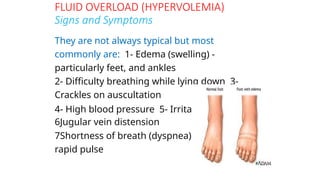 edema @ ppt 2212weerwqrqwr3eqrewrerrrrrrrrer | PPTX