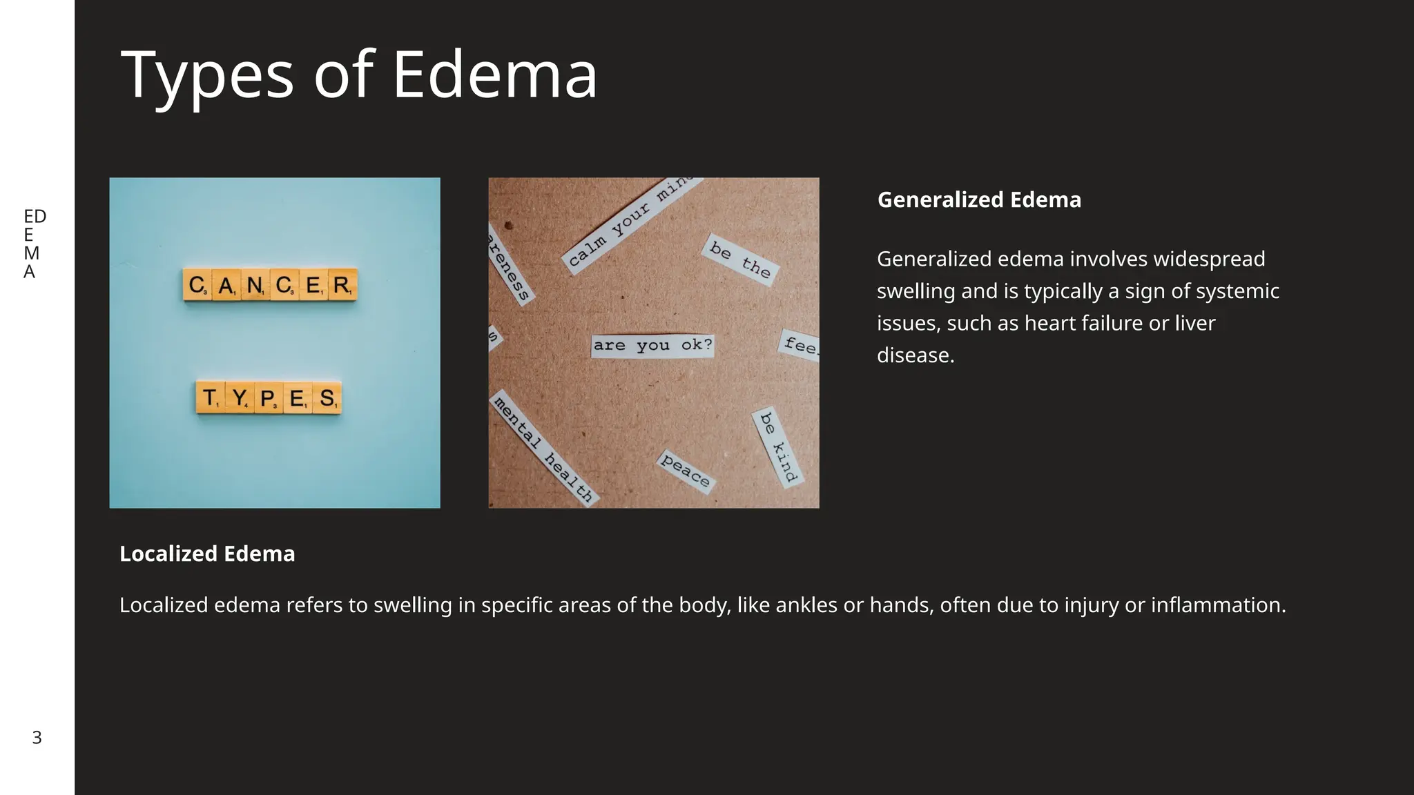 Edema | Definition, Causes, symptoms & diagnosis | PPTX