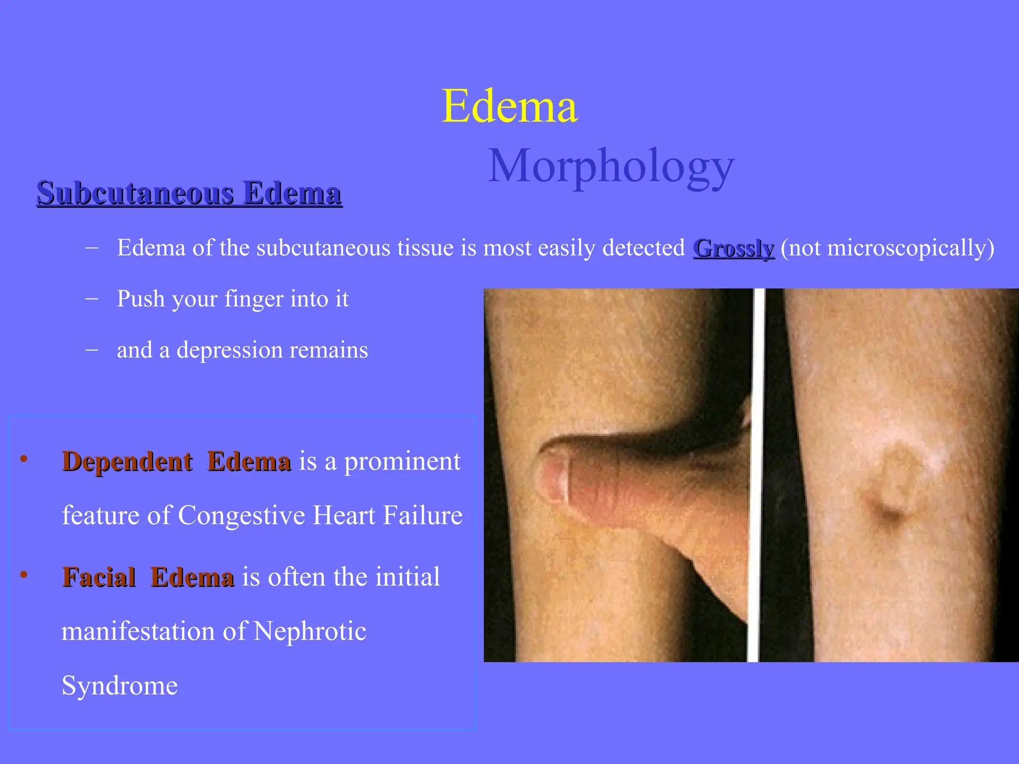 EDEMA.pptEDEMA.pptEDEMA.pptEDEMA.pptEDEMA.ppt