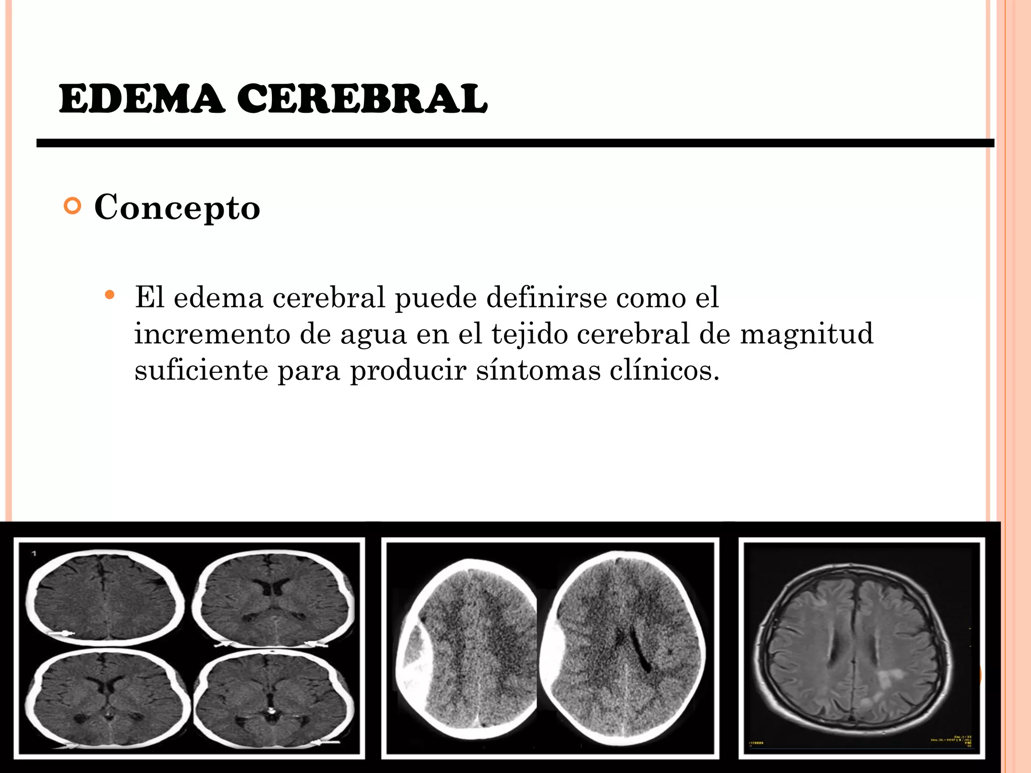 Edema cerebralnosografia-1220743905781948-8 | PPT