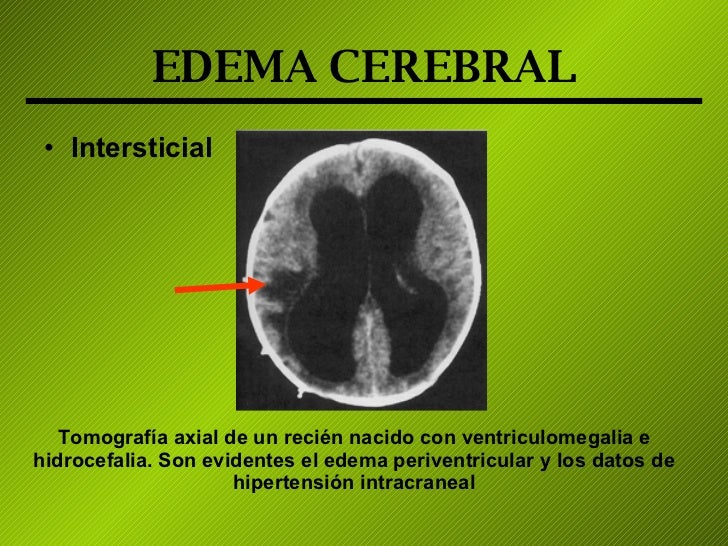 HCM - Nosografia - Edema Cerebral