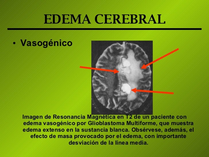 HCM - Nosografia - Edema Cerebral