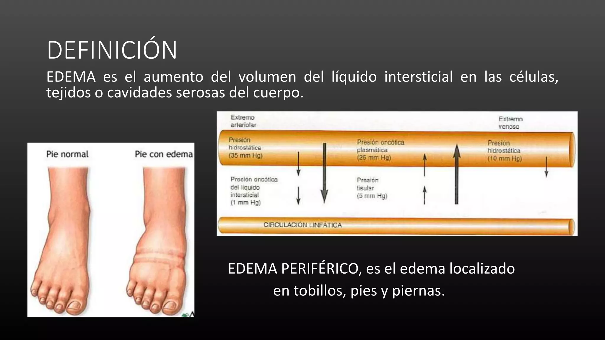 Edema periferico-semiologia | PPTX | Diseases and Conditions | Medical ...