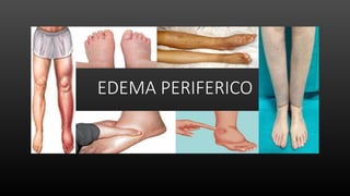 Edema periferico-semiologia | PPTX