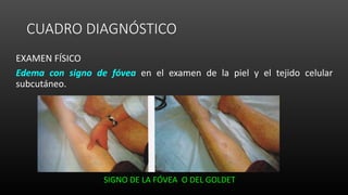 Edema periferico-semiologia | PPTX