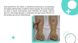 Edema - Semiologia.pptx