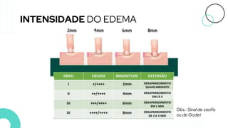 Edema - Semiologia.pptx