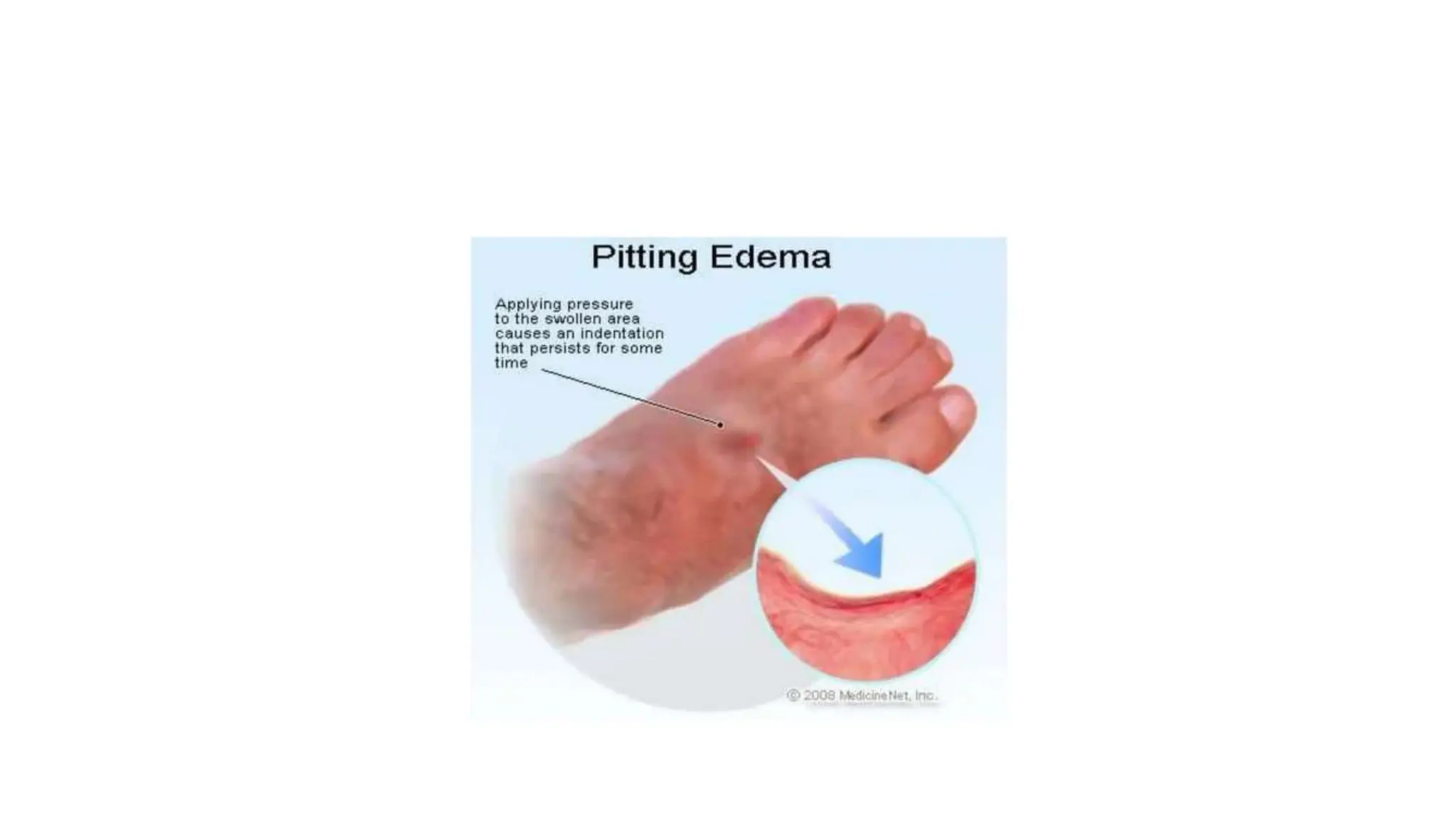 edema_1.pptx important for nurses to recognise the types of edemdemas ...