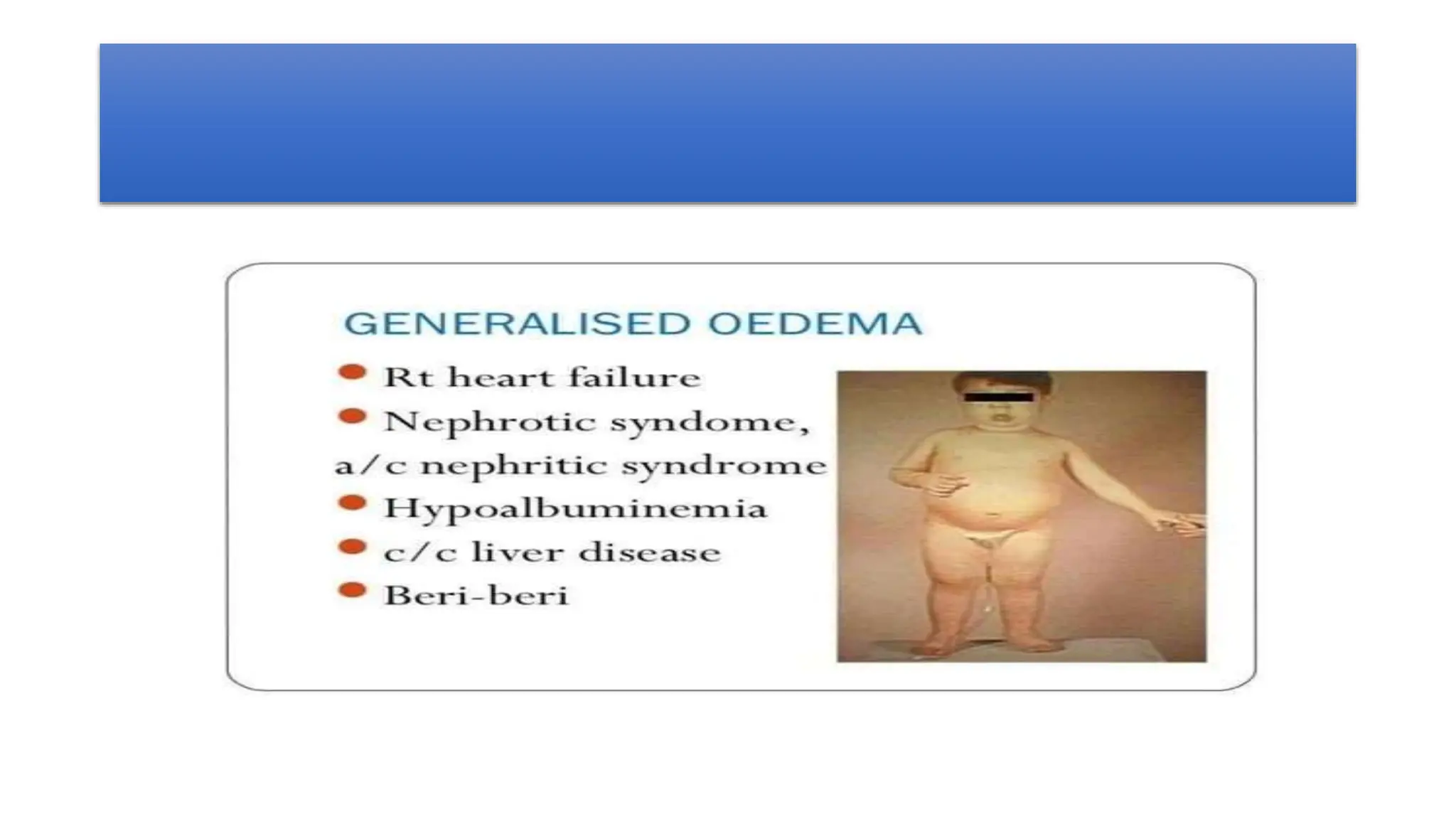 edema_1.pptx important for nurses to recognise the types of edemdemas ...