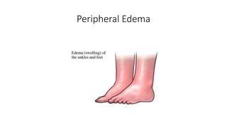 edema_1.pptx important for nurses to recognise the types of edemdemas ...