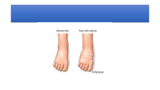 edema_1.pptx important for nurses to recognise the types of edemdemas ...