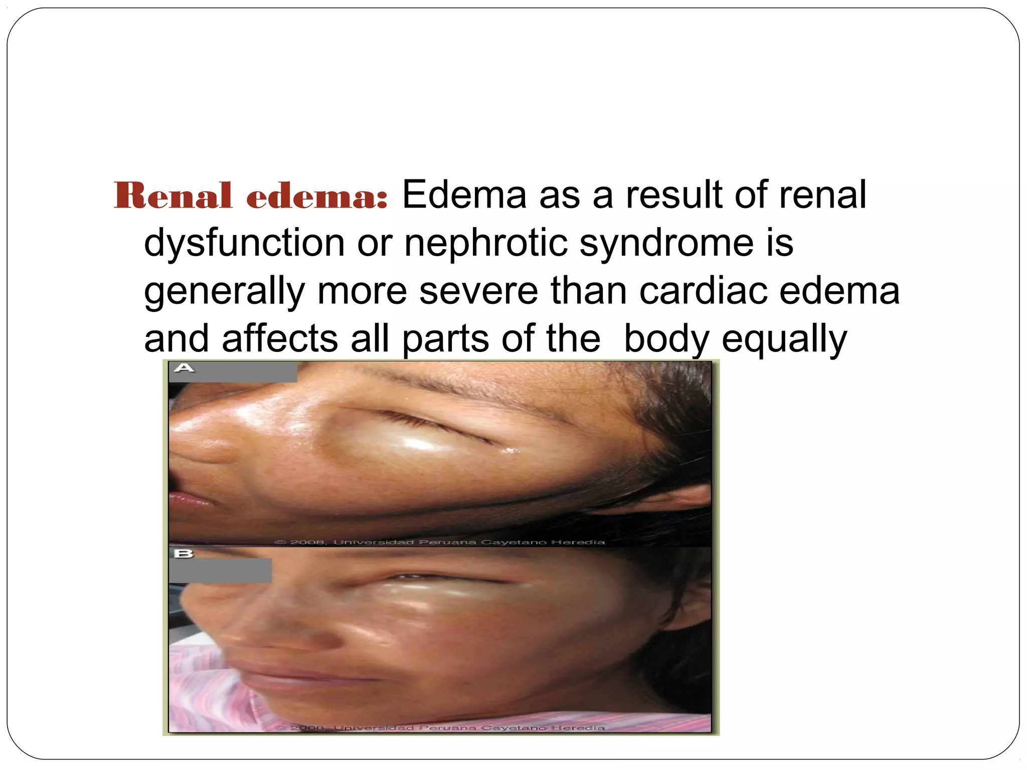 Edema | PPT