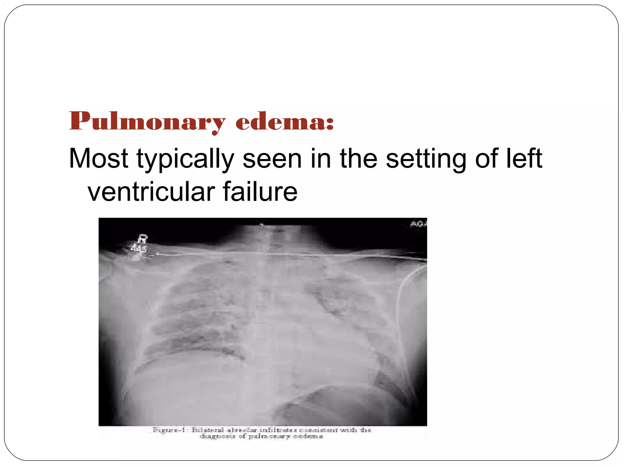 Edema | PPT