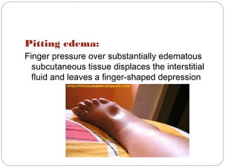 Edema | PPT