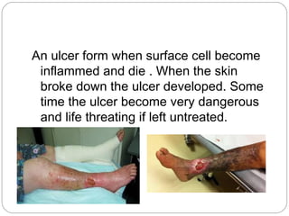 Edema | PPT