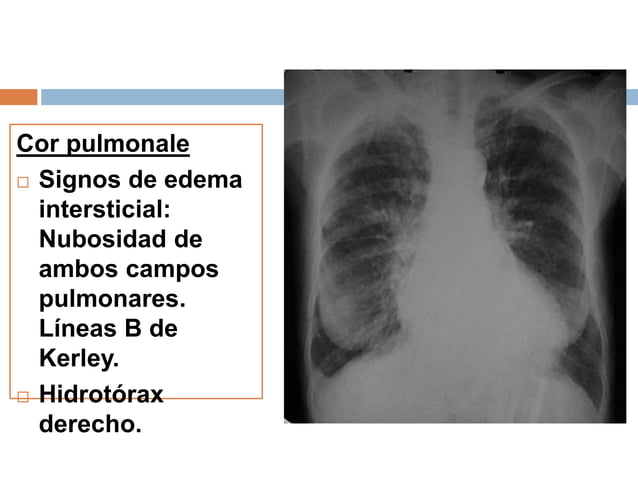 Edema agudo del pulmon | PPTX