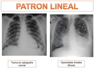 Radiografía De Edema Pulmonar