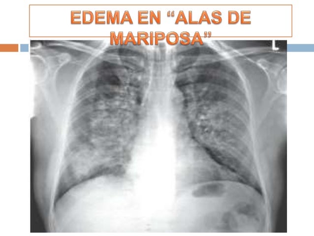 Edema agudo del pulmon