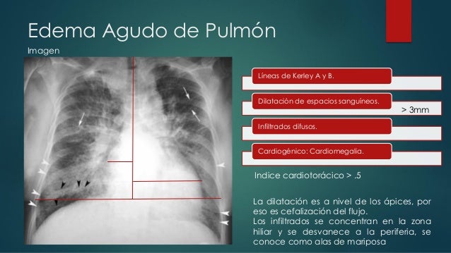 Edema agudo de pulmón