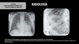Edema Agudo De Pulmón | PPTX