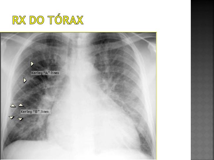 Edema agudo de pulmão 1
