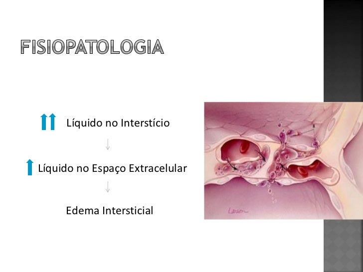 Edema agudo de pulmão 1