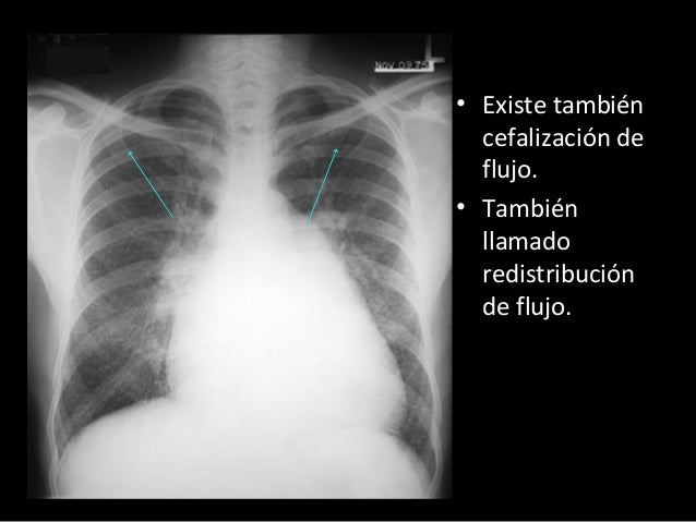 Edema agudo de pulmon