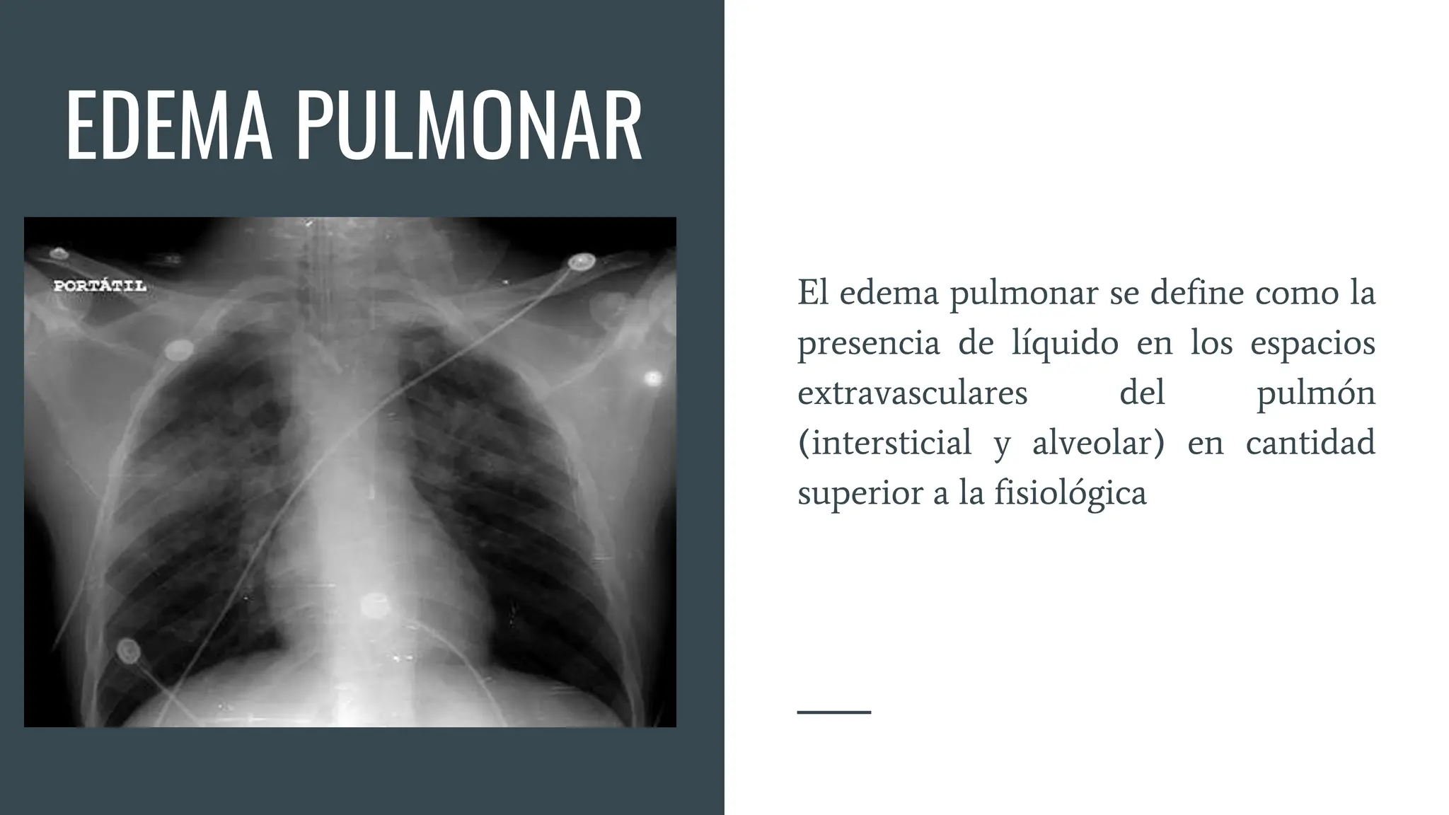 Edema agudo pulmonar .pptx