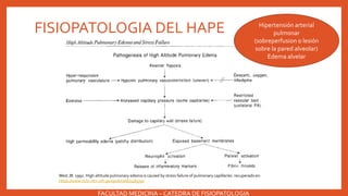 Edema agudo pulmonar de altura (hape) | PDF