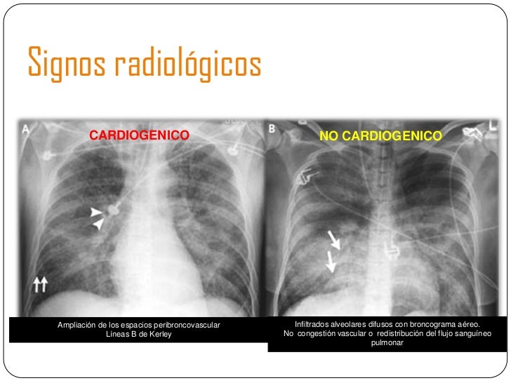 Padrao De Borboleta De Raio X De Edema Pulmonar