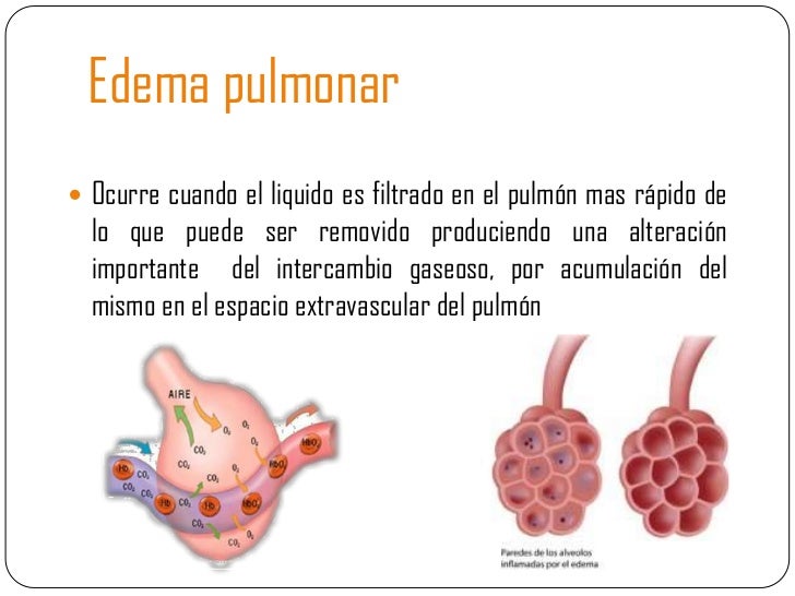 Edema Pulmonar