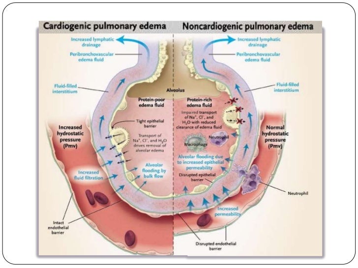 Edema agudo de pulmon no cardiogenico