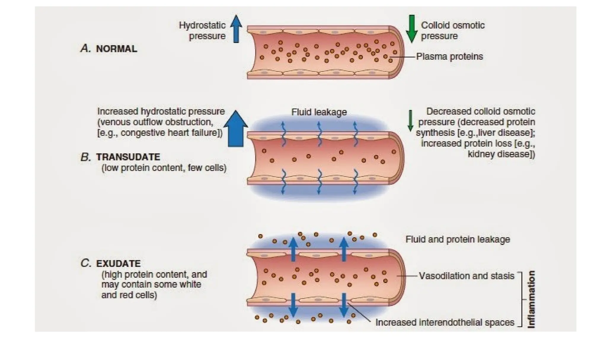 Hemodynamic Disorders . Edema , Effusion , Hyperemia Congestion.pptx Dr ...