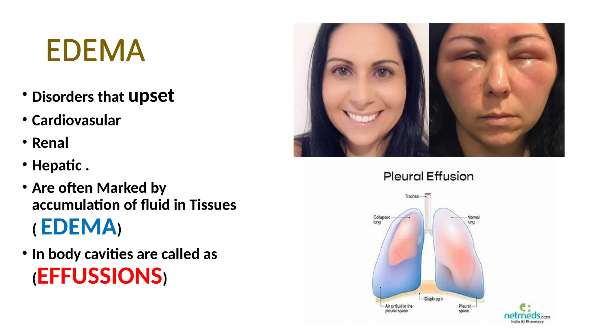 Hemodynamic Disorders . Edema , Effusion , Hyperemia Congestion.pptx Dr ...