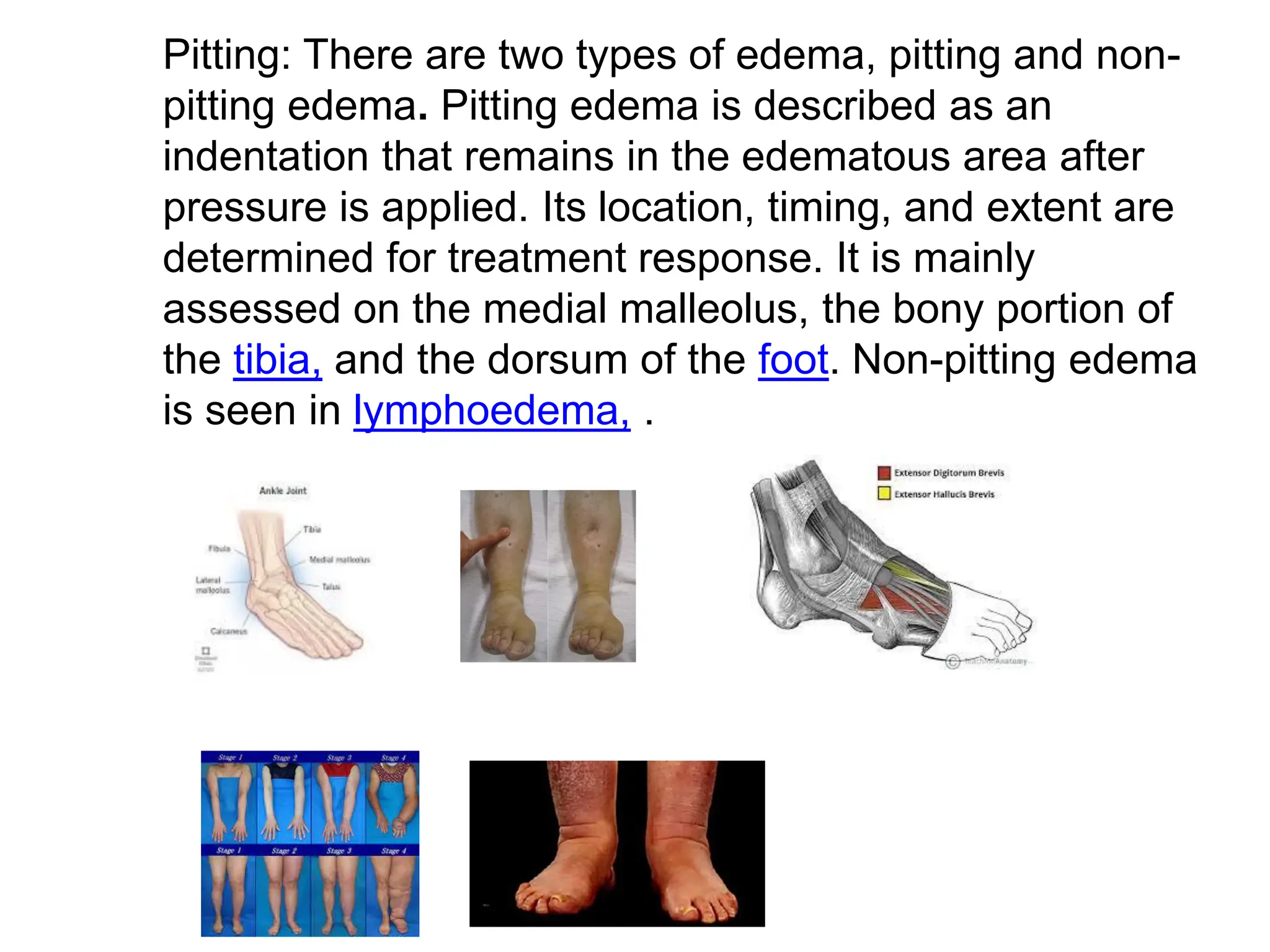 Edema and Malnutrition(Nutrition and Health) | PPT