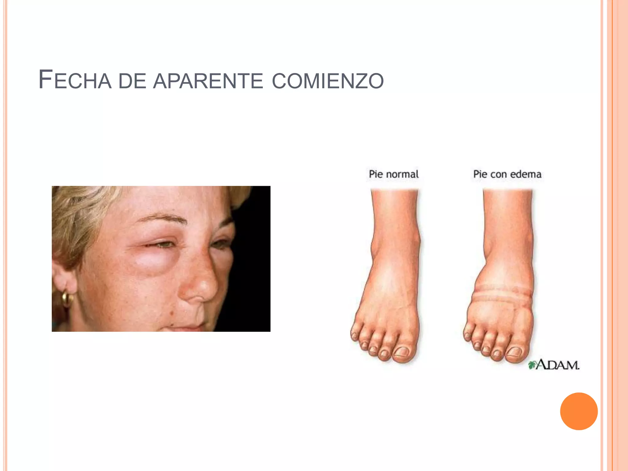 Edema cardiaco | PPTX