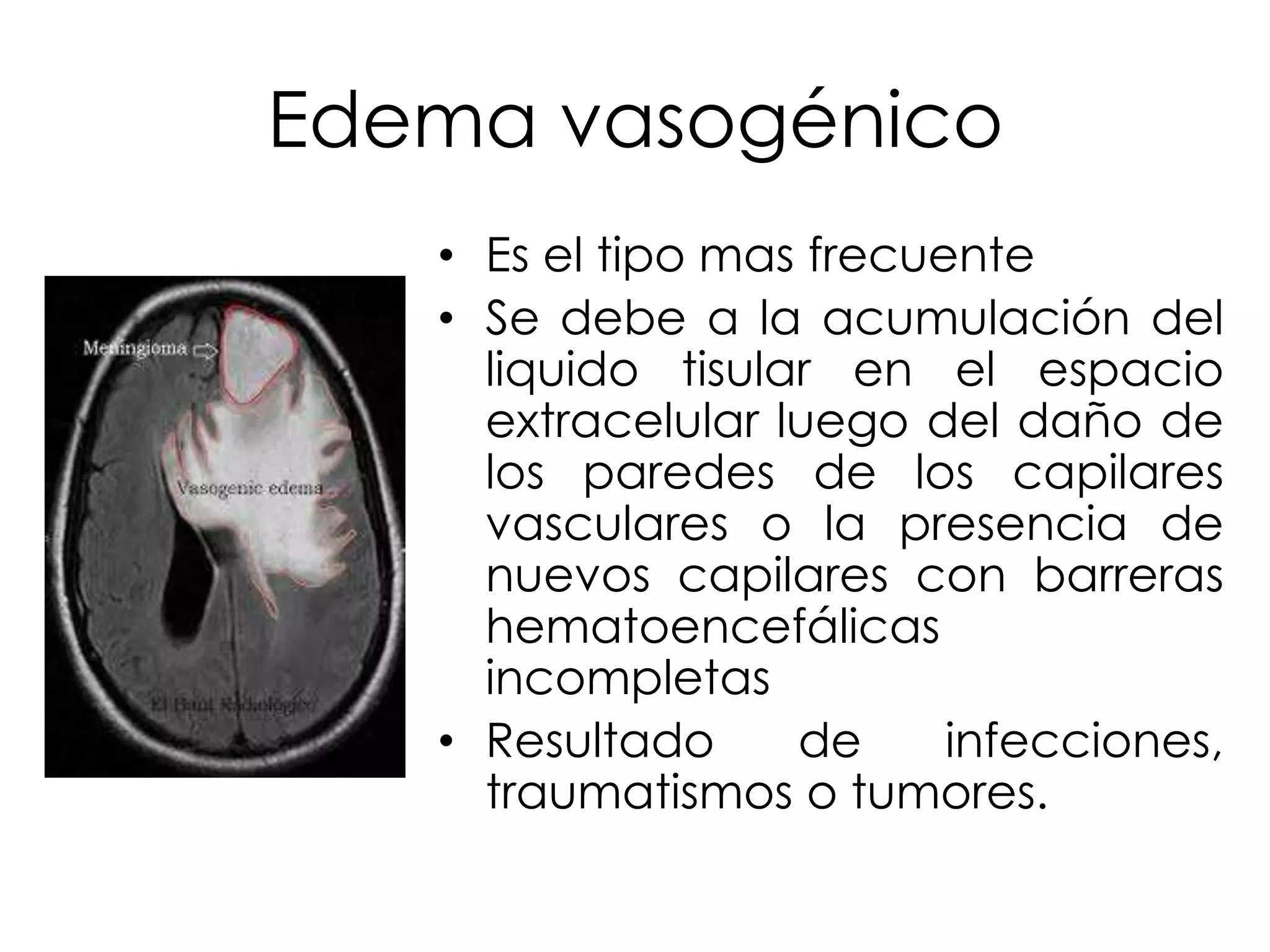 Edema cerebral | PPTX