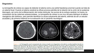 Edema cerebral | PPTX
