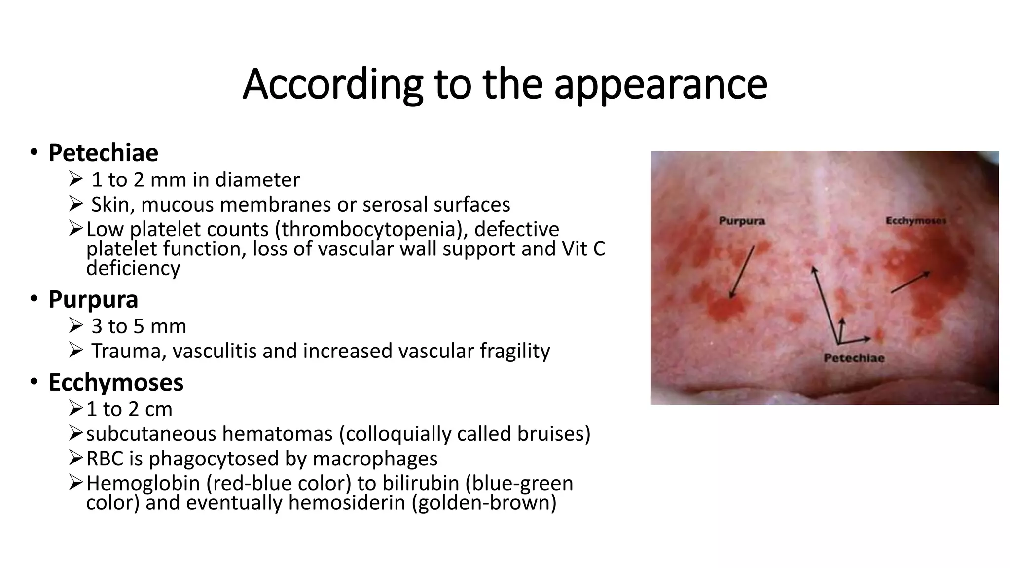 Edema congestion 15th.pdf