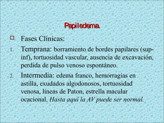 Edema de papila oftalmo peditria nino | PPT