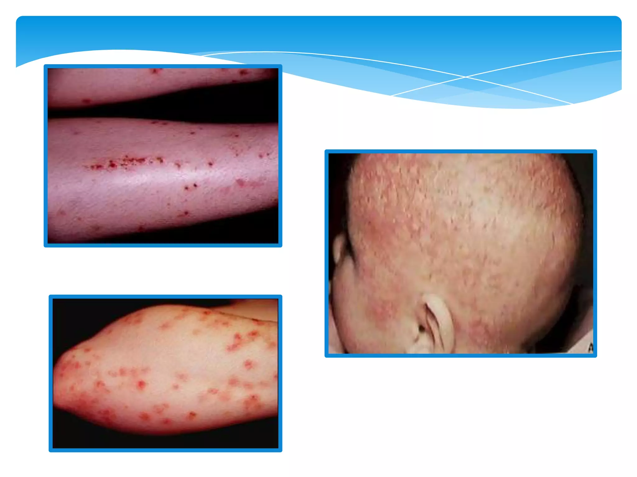 Edema dermico prurito urtticaria | PPT