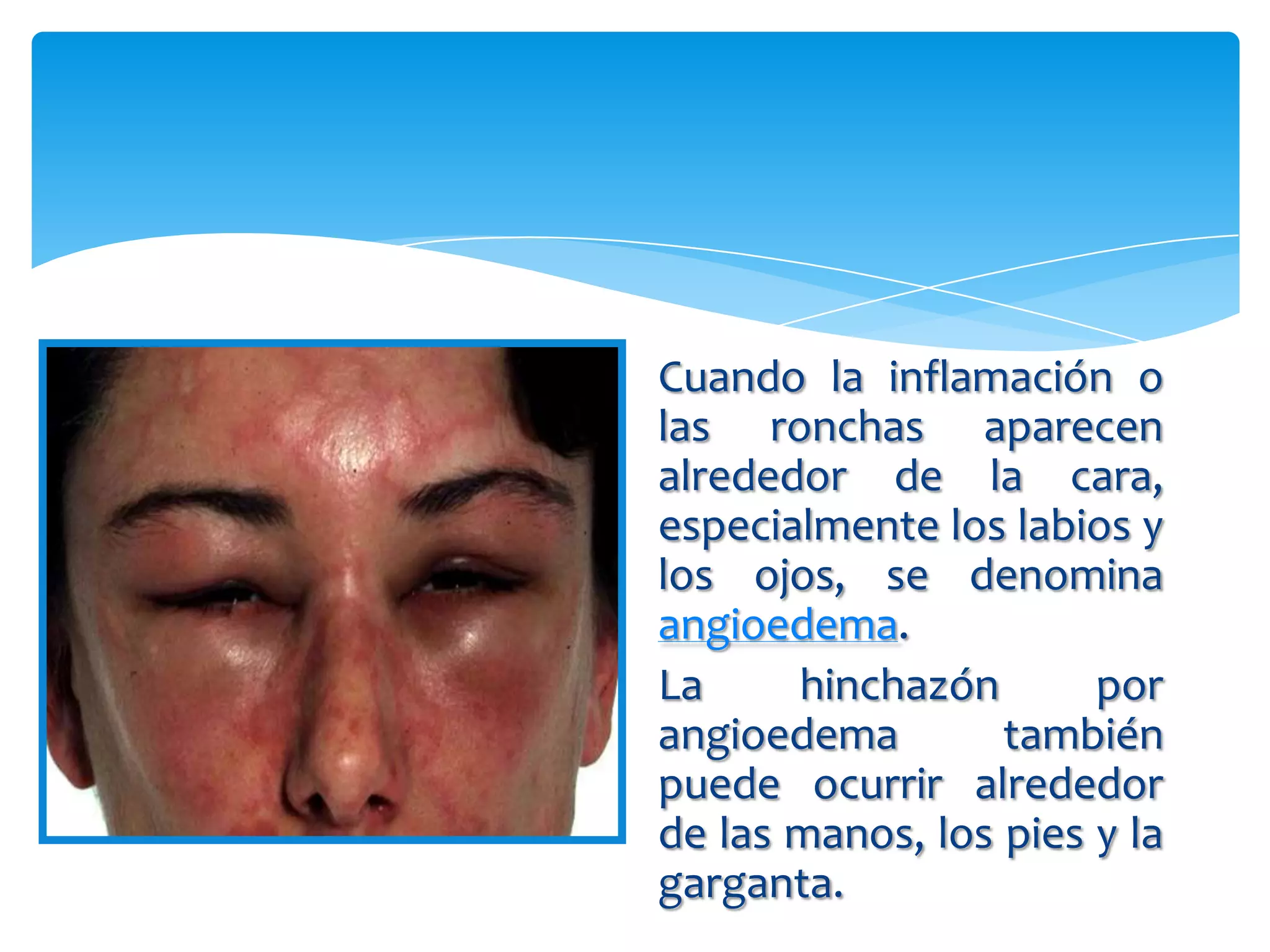 Edema dermico prurito urtticaria | PPT