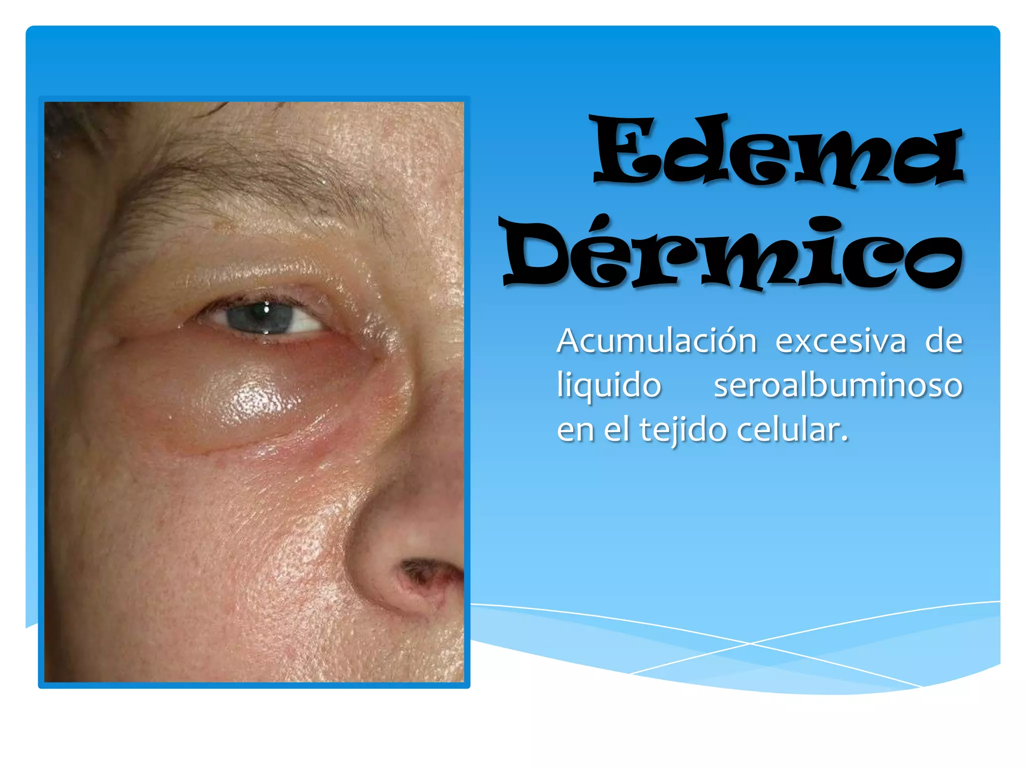 Edema dermico prurito urtticaria | PPT
