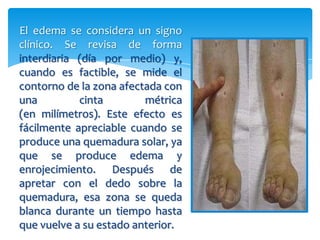 Edema dermico prurito urtticaria | PPTX