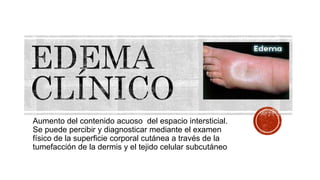 Edema diapositivas.pptx