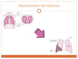 Edema especializado | PPT