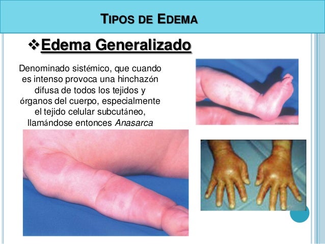 Edema expo