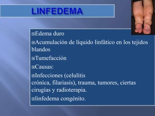 Edema | PPT
