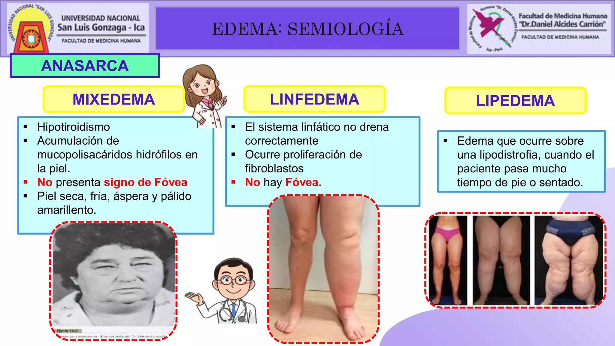 EDEMA_FISIOPATOLOGiATIPOS_Y_CARACTERSTICAS.pptx