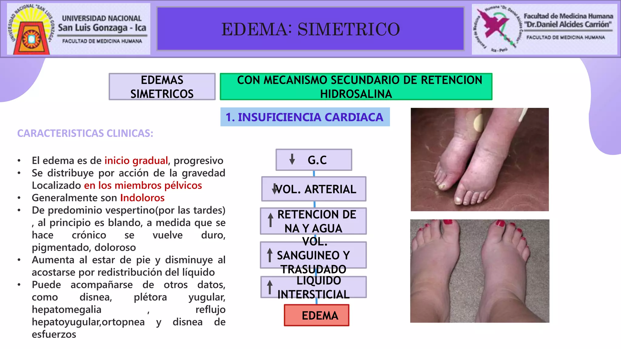 EDEMA_FISIOPATOLOGiATIPOS_Y_CARACTERSTICAS.pptx